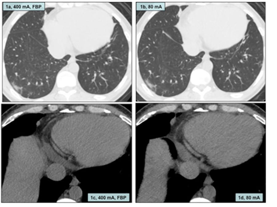 Role Of Iterative Reconstruction Technique For Low Dose Chest Ct